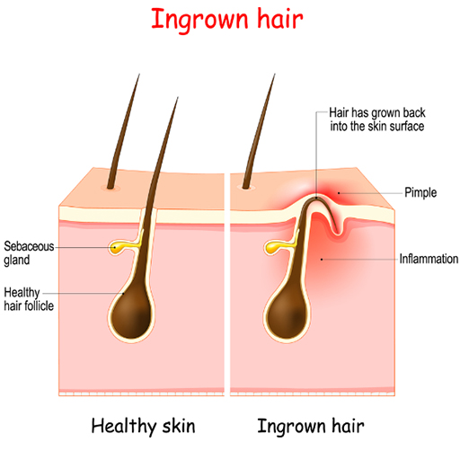Ingrown Hairs Causes Prevention And Treatments Eshaistic Blog
